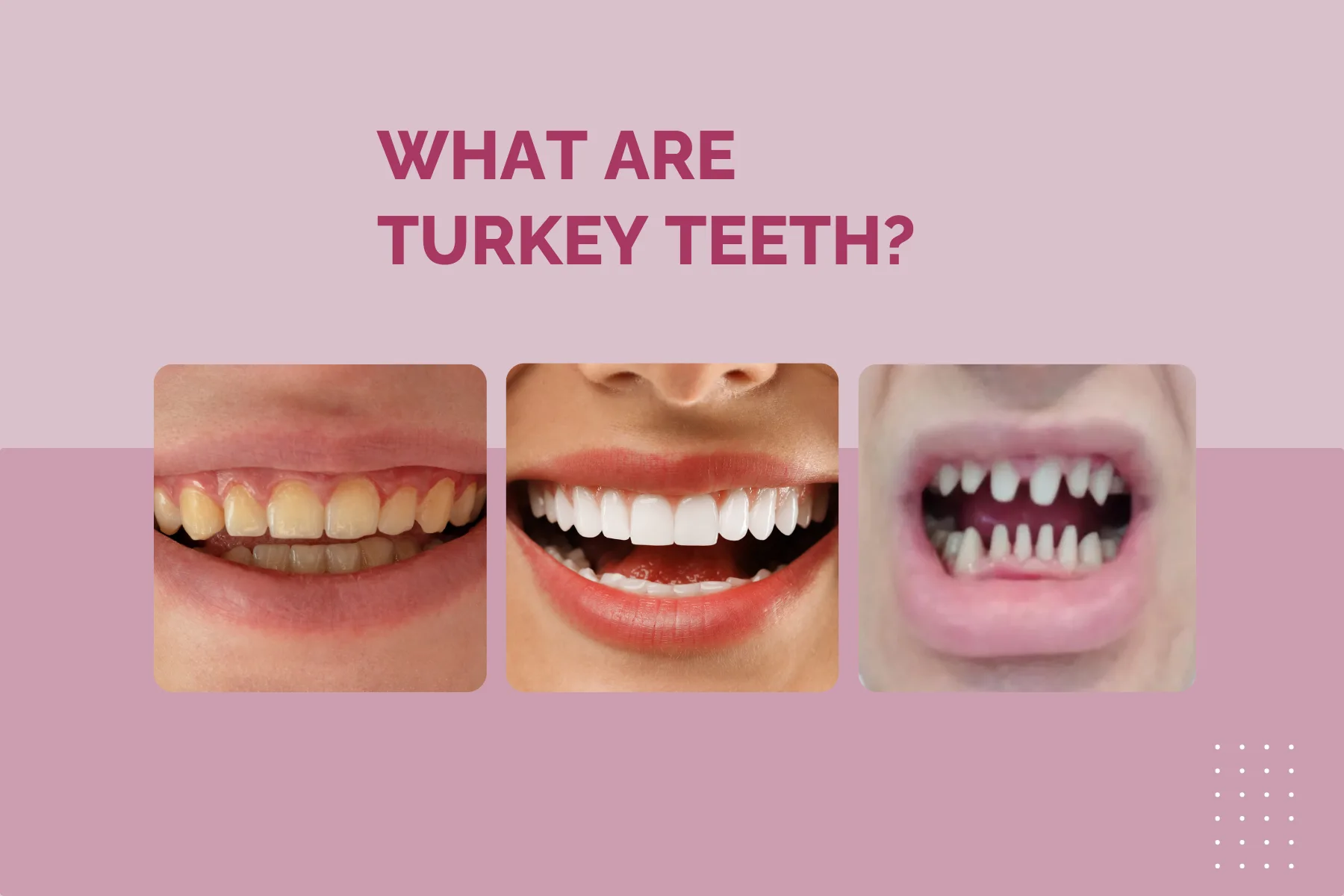 What Are Turkey Teeth? Getting to the Truth.