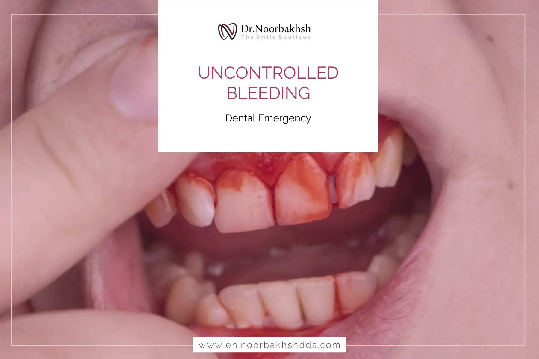 How to Handle Uncontrolled Bleeding Dental Emergency Quickly